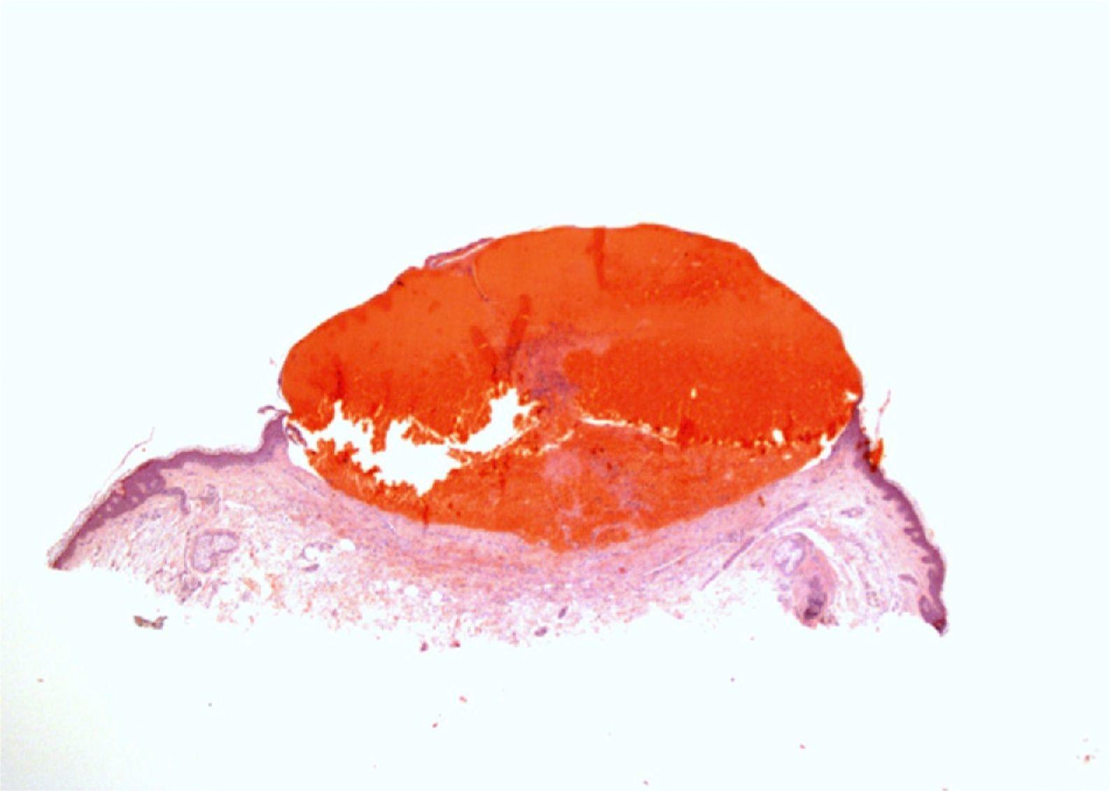 Bullous Hemorrhagic Dermatosis at Distant Sites: A Report of 2 New ...