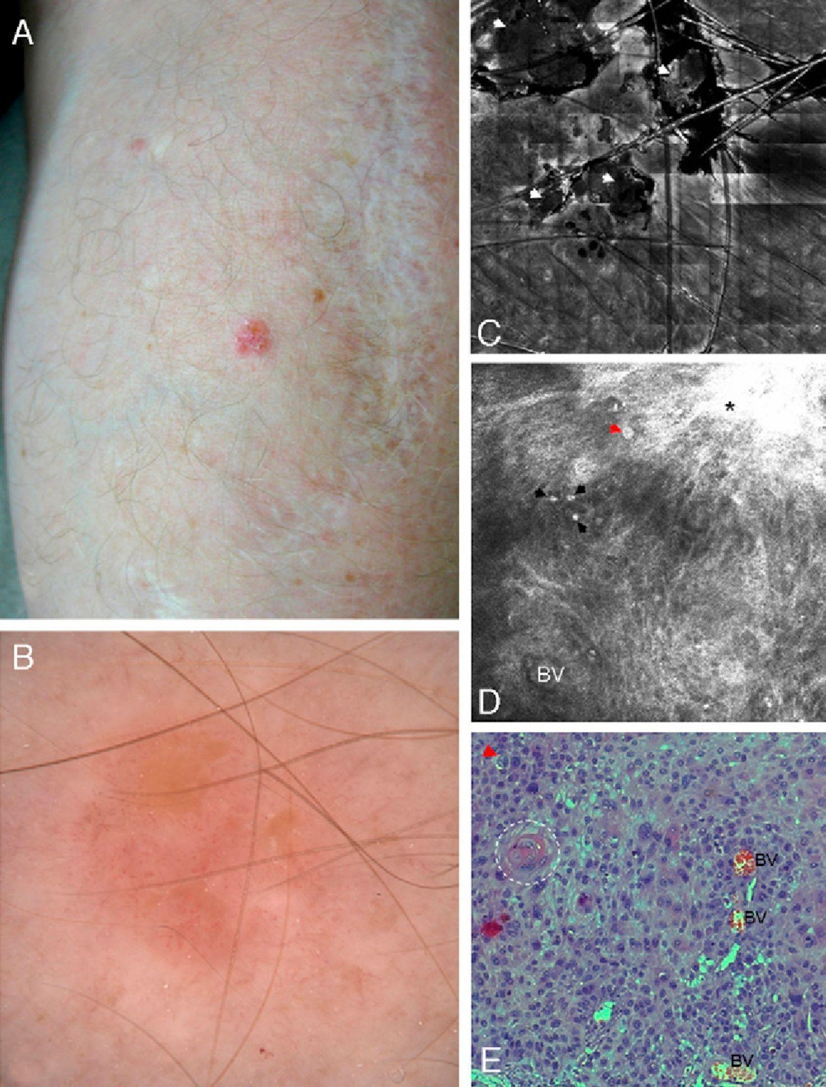 In vivo reflectance confocal microscopy for early diagnosis of ...