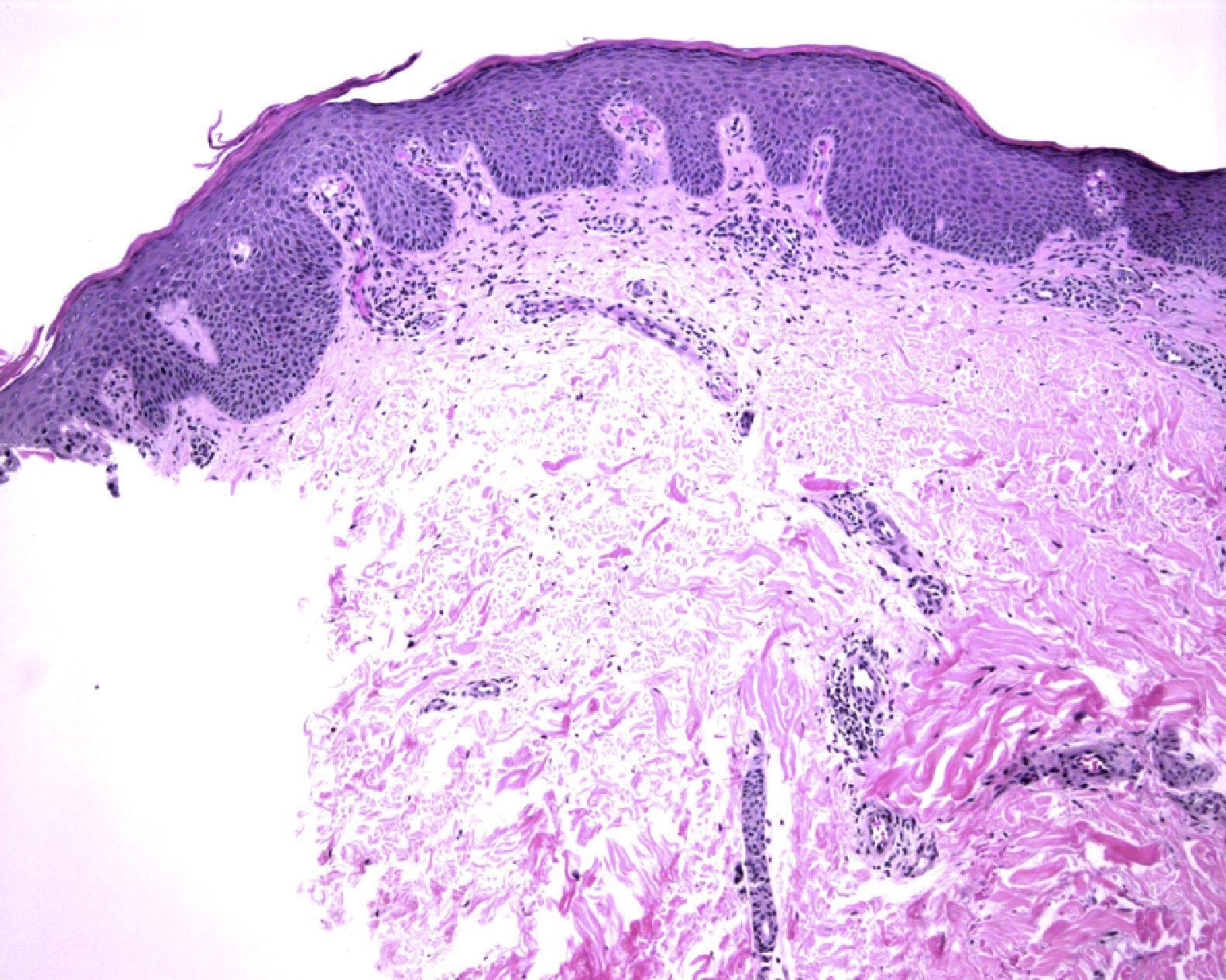 Hidradenitis Suppurativa Histology