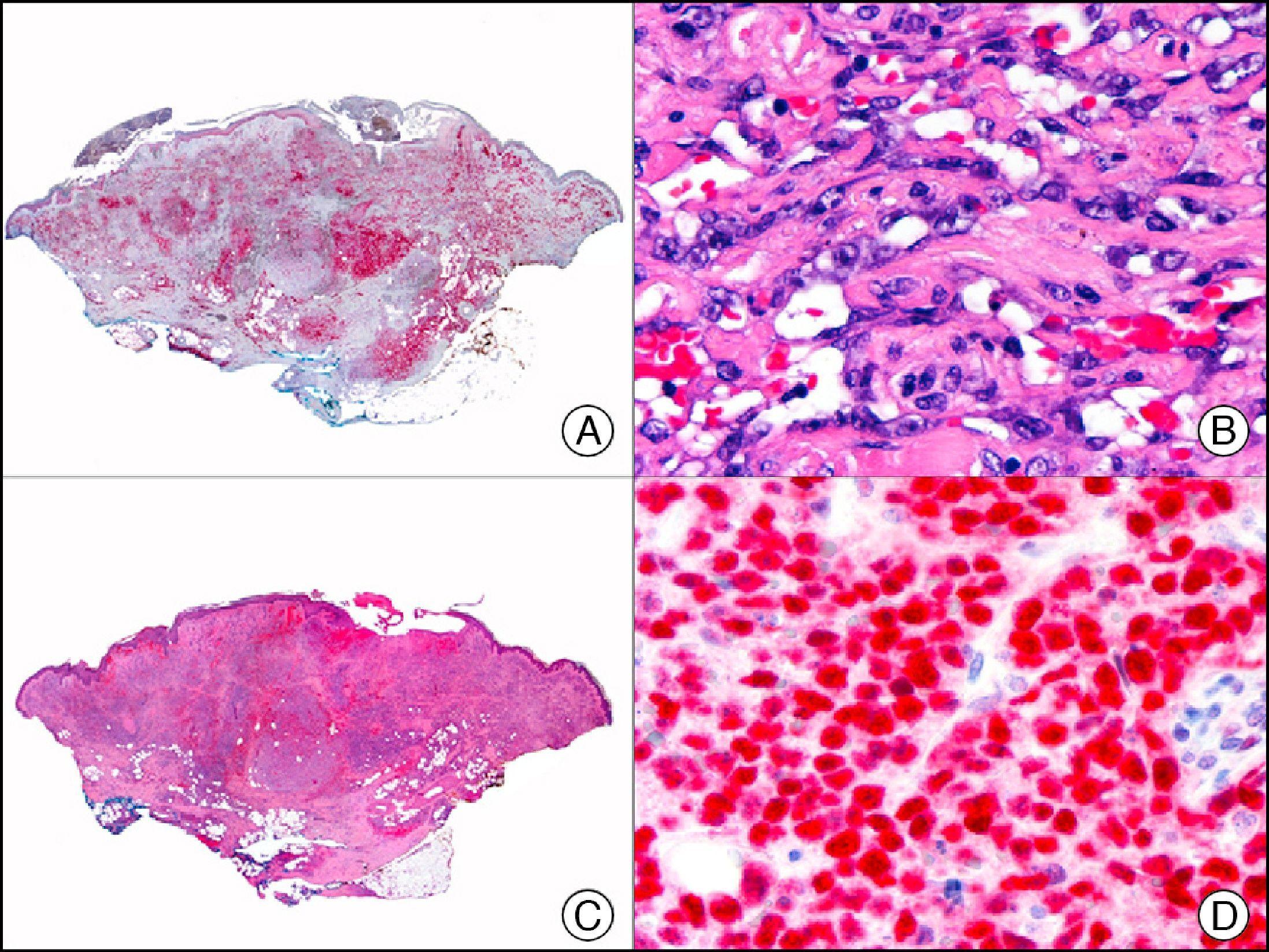Immunohistochemistry in Dermatopathology: A Review of the Most Commonly ...