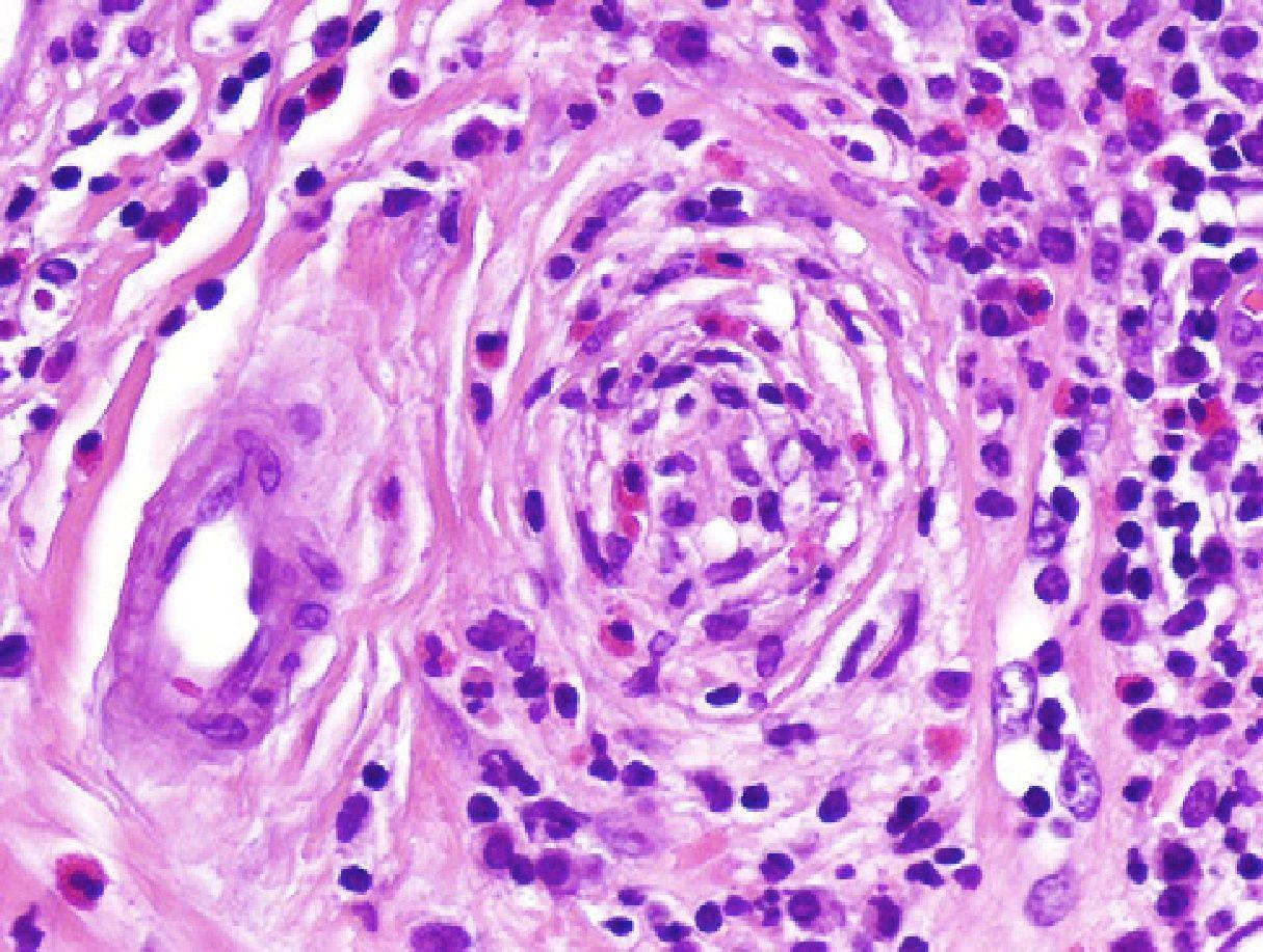 Atrophic Plaque of 8 Years’ Duration on the Scalp | Actas Dermo ...