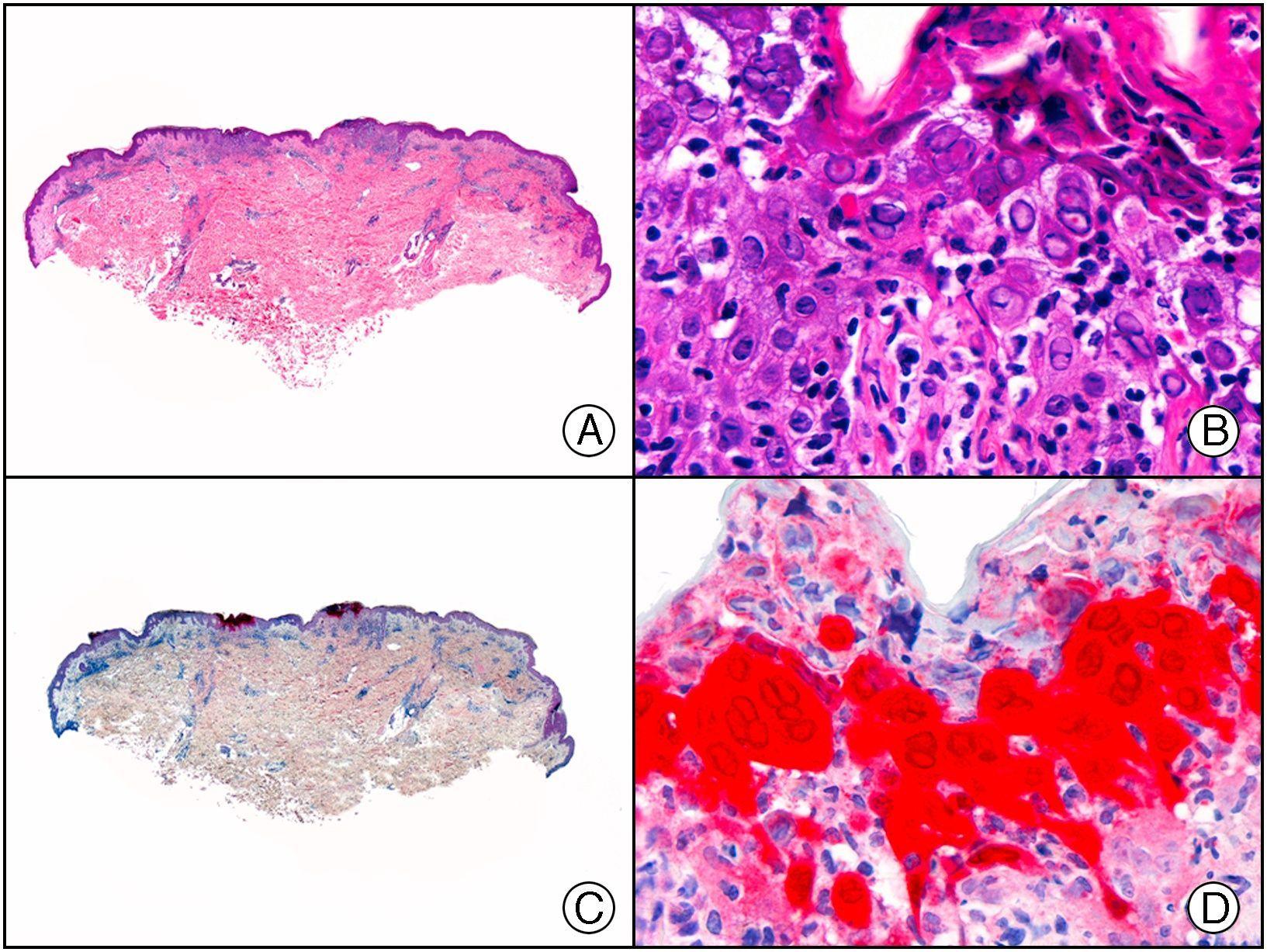 Immunohistochemistry in Dermatopathology: A Review of the Most Commonly ...