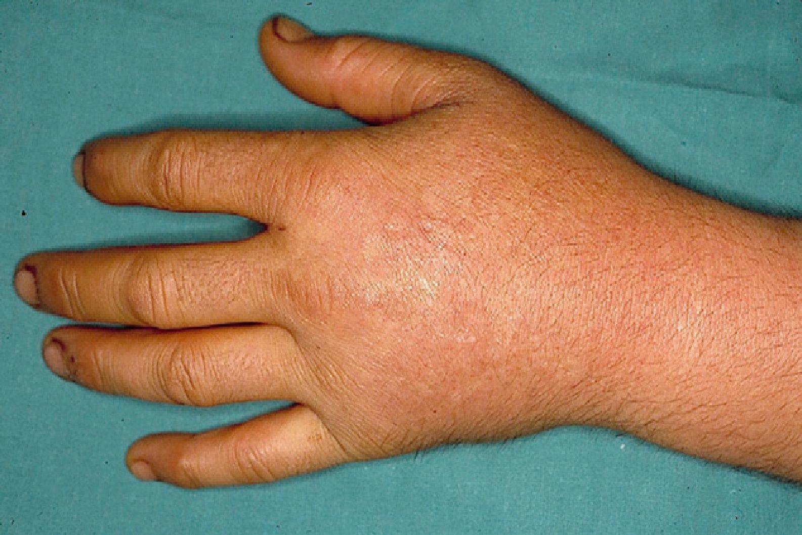 Erythropoietic Protoporphyria