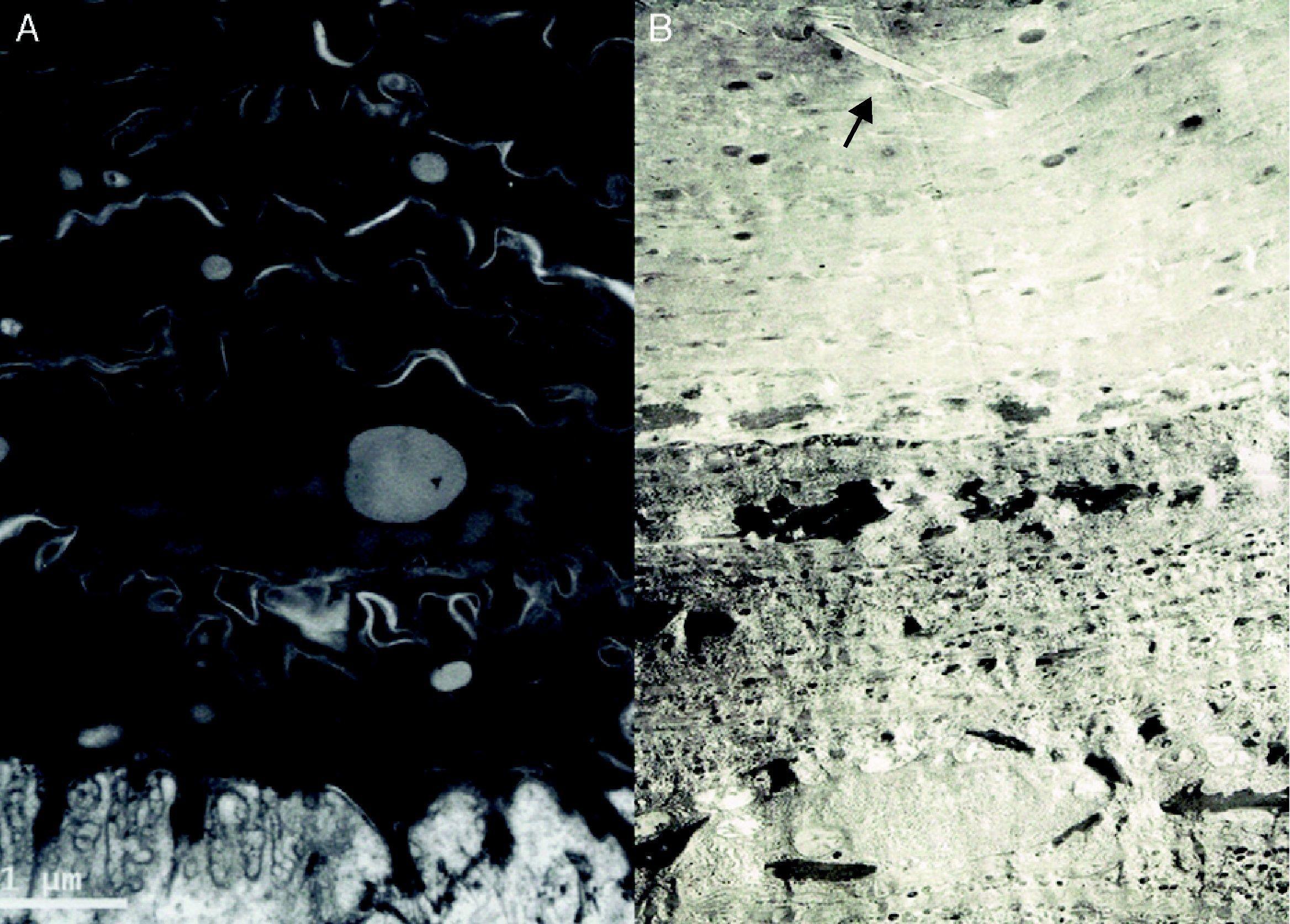 Autosomal Recessive Congenital Ichthyosis | Actas Dermo-Sifiliográficas