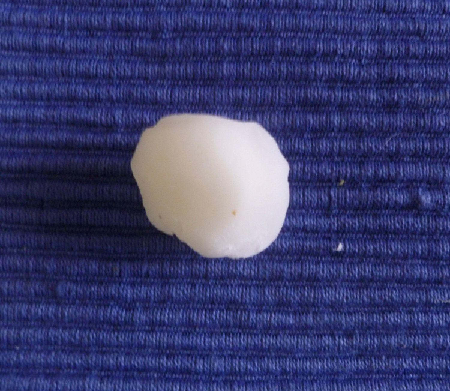 Bone Wax in Dermatologic Surgery | Actas Dermo-Sifiliográficas