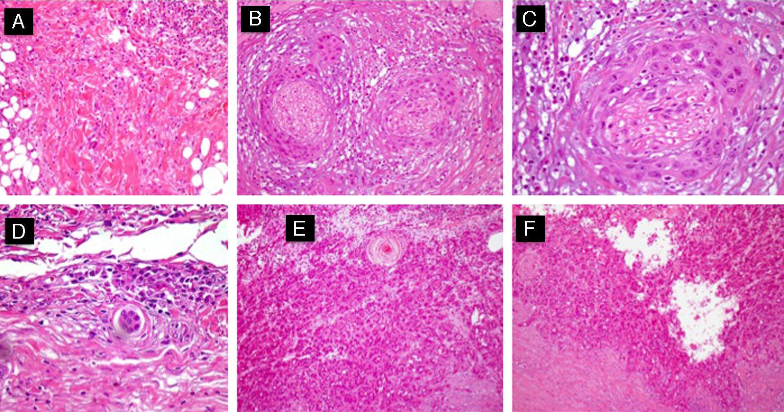 Basal Cell Carcinoma Vs Squamous Cell Carcinoma Histology