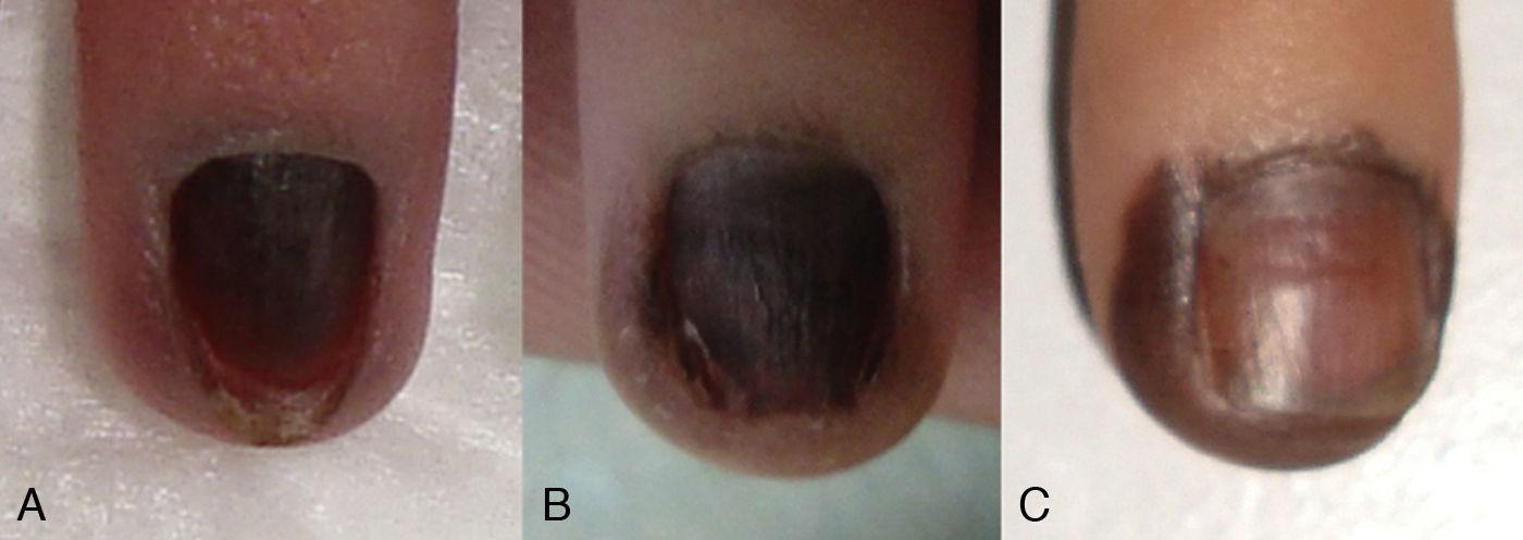 Congenital Subungual and Periungual Melanocytic Nevus | Actas Dermo ...