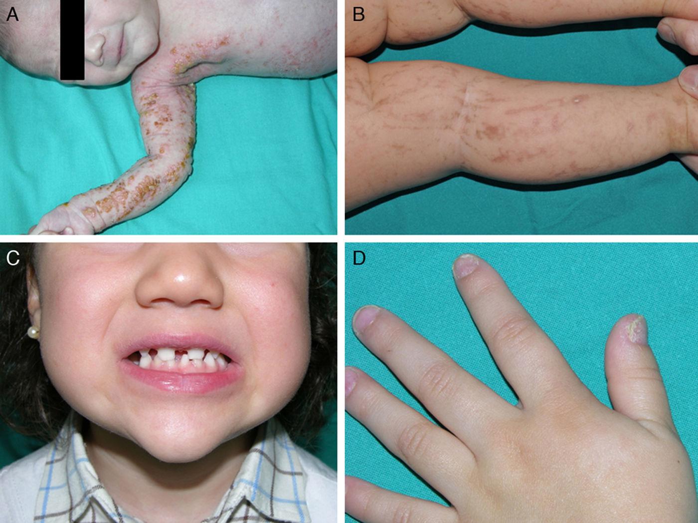 Children With Ectodermal Dysplasia
