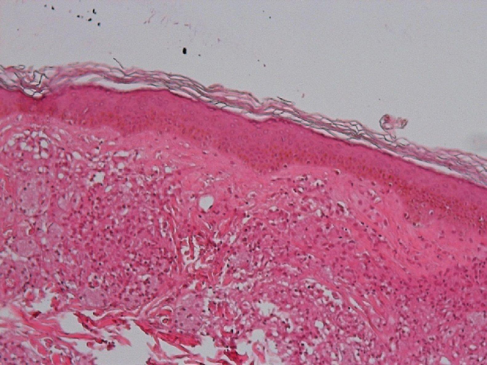 Leprosy. An Update: Definition, Pathogenesis, Classification, Diagnosis ...