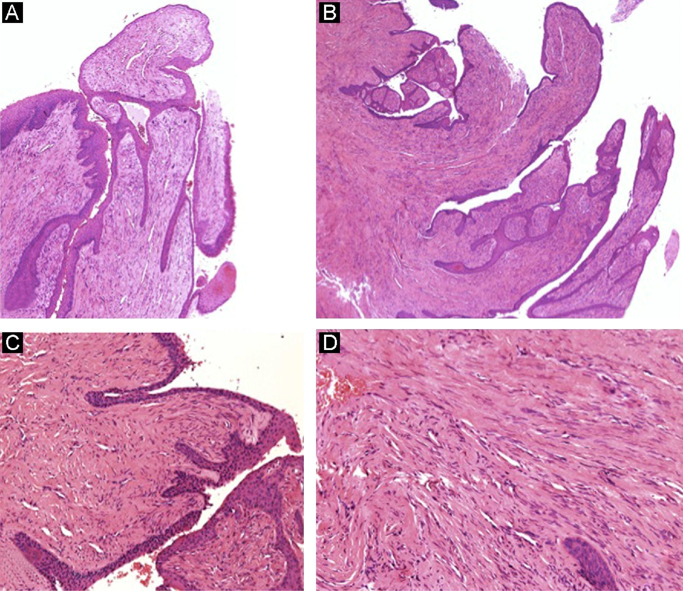 Acanthosis Histology