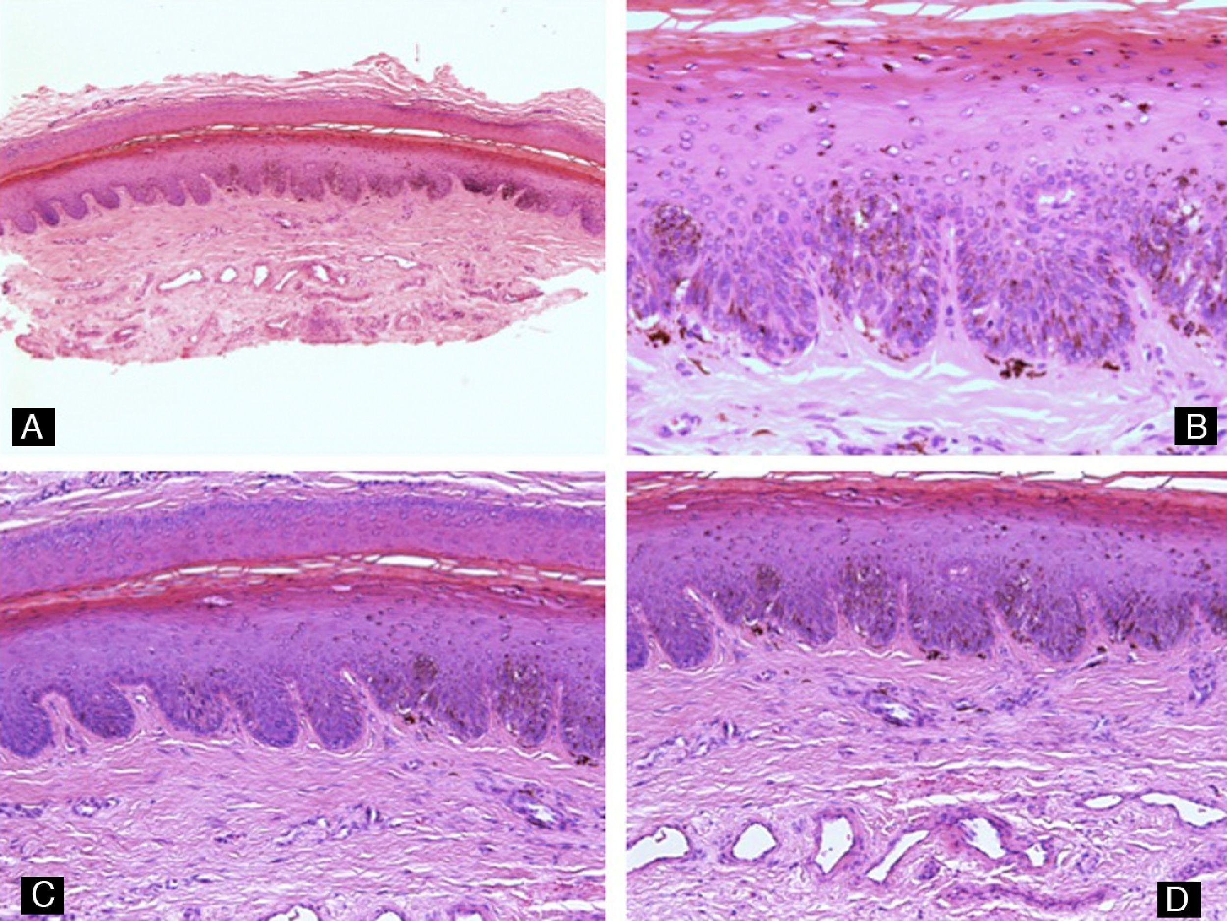 Nail Histopathology | Actas Dermo-Sifiliográficas