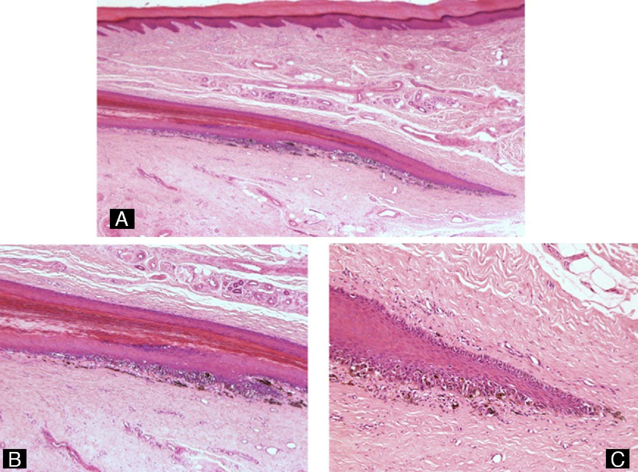 Nail Histopathology | Actas Dermo-Sifiliográficas