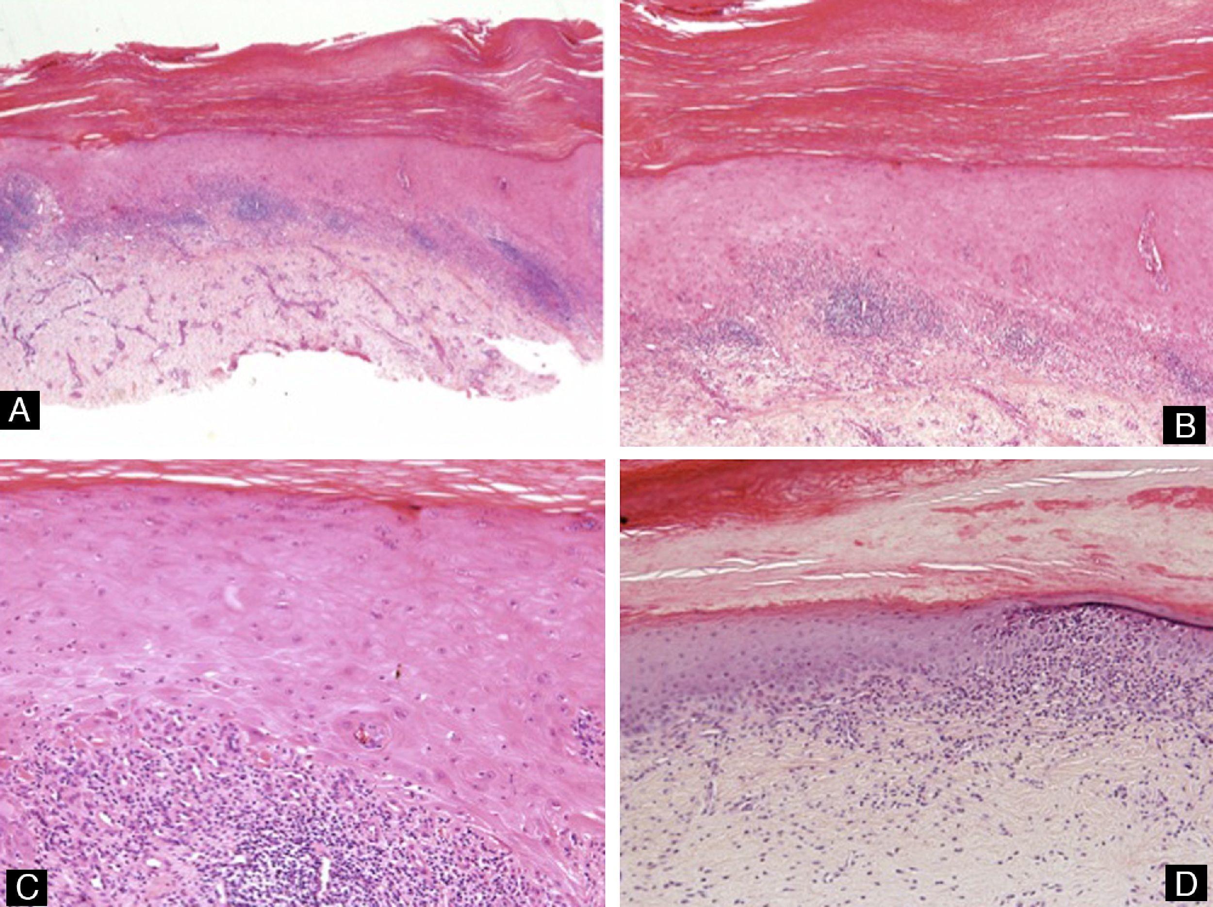 Acanthosis Histology