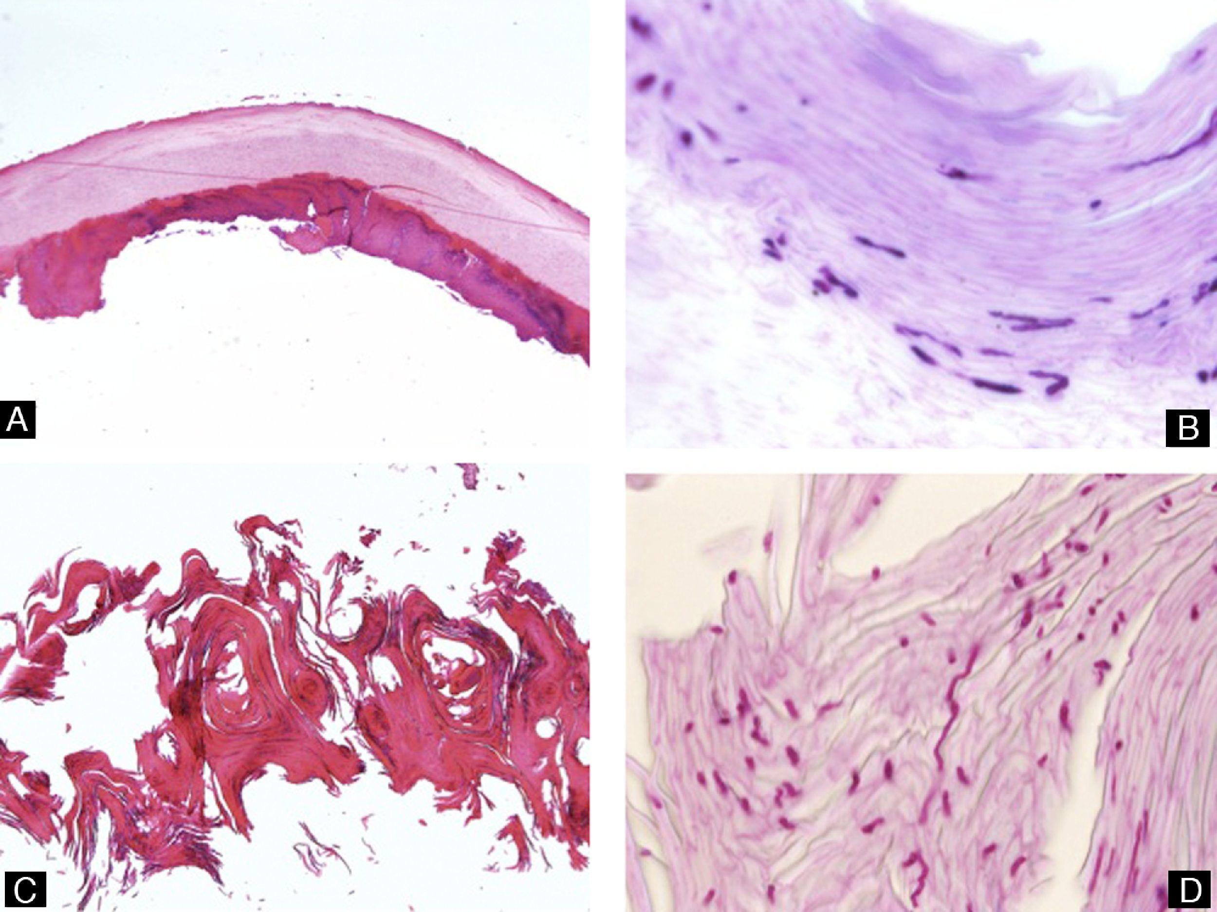 Nail Histopathology | Actas Dermo-Sifiliográficas