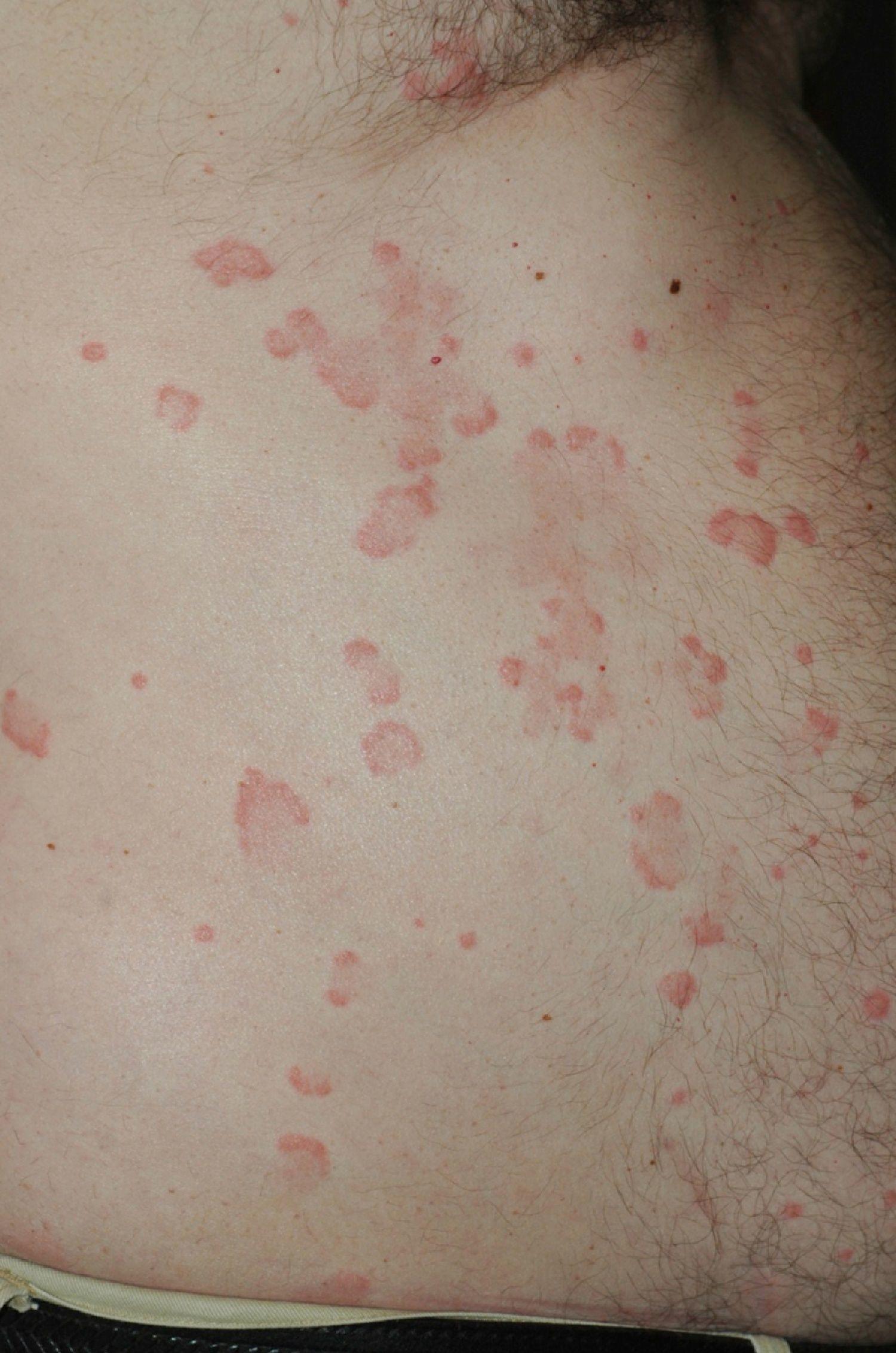 Urticarial Vasculitis Face