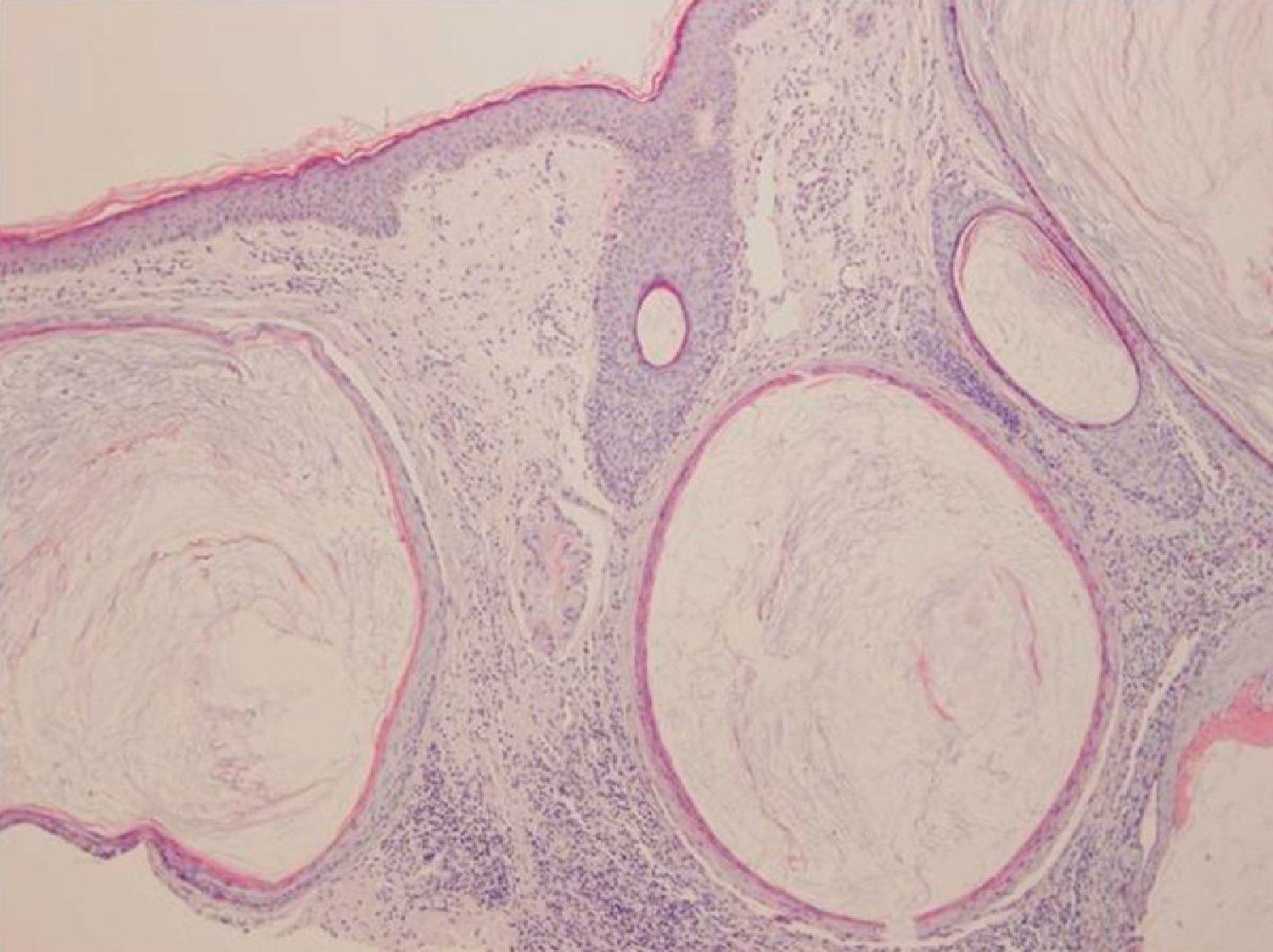 Milia en Plaque | Actas Dermo-Sifiliográficas