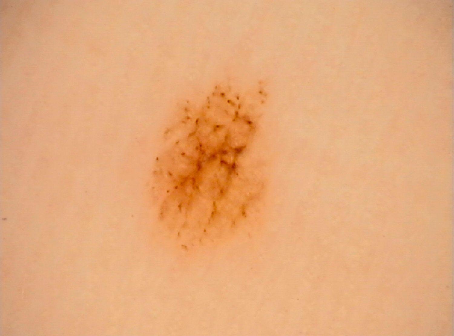 Dermoscopic Patterns of 158 Acral Melanocytic Nevi in a Latin American ...