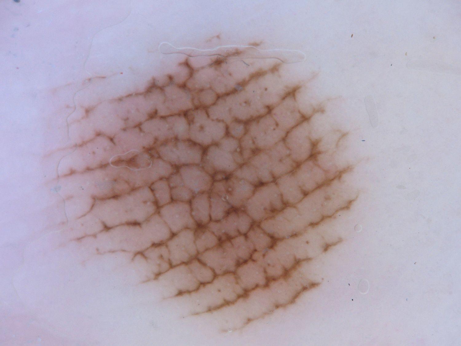 Melanocytic Nevus Palm