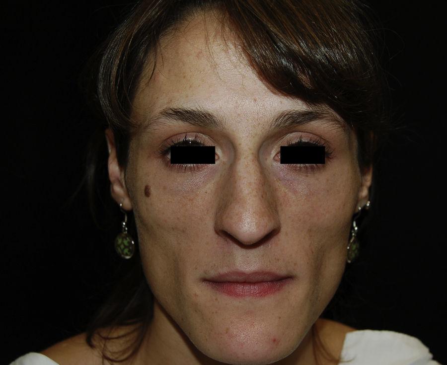 Adult Dermatomyositis Associated With Lipodystrophy | Actas Dermo ...