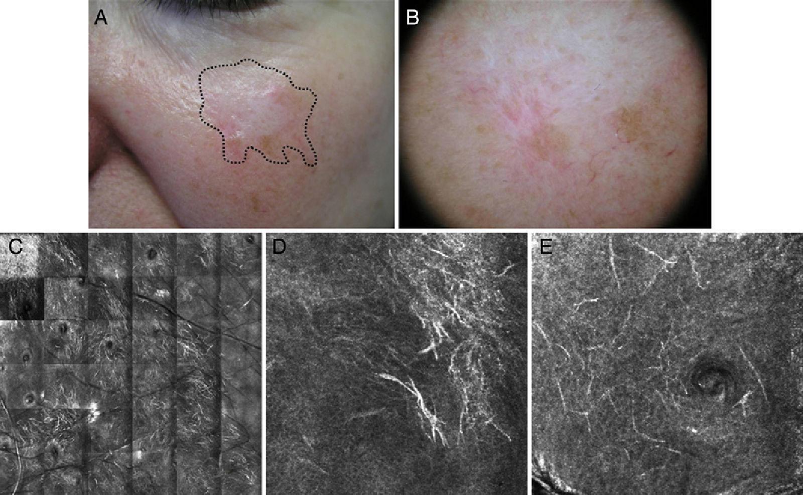 Lentigo Maligna | Actas Dermo-Sifiliográficas
