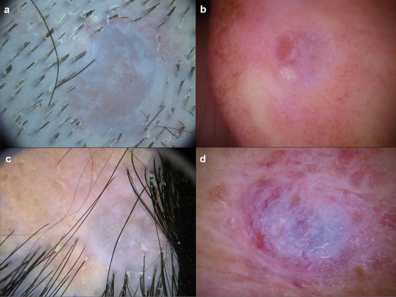 Dermatoscopy of Apocrine Tumors: Report of 4 Cases | Actas Dermo ...