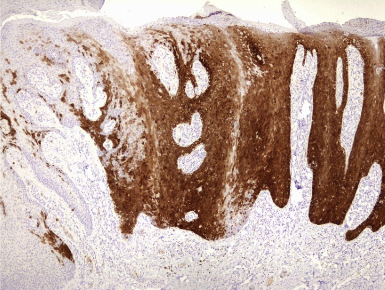 Periungual Bowenoid Papulosis Due to Human Papillomavirus Type 42 ...