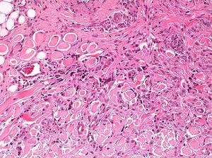 Dermatofibroma of the Face: A Clinicopathologic Study of 20 Cases ...