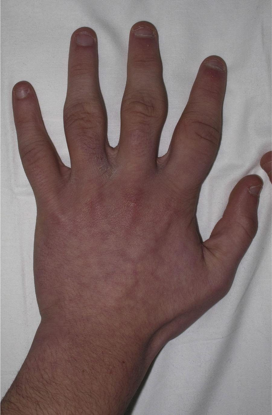 Pachydermodactyly Successfully Treated With Triamcinolone Injections ...