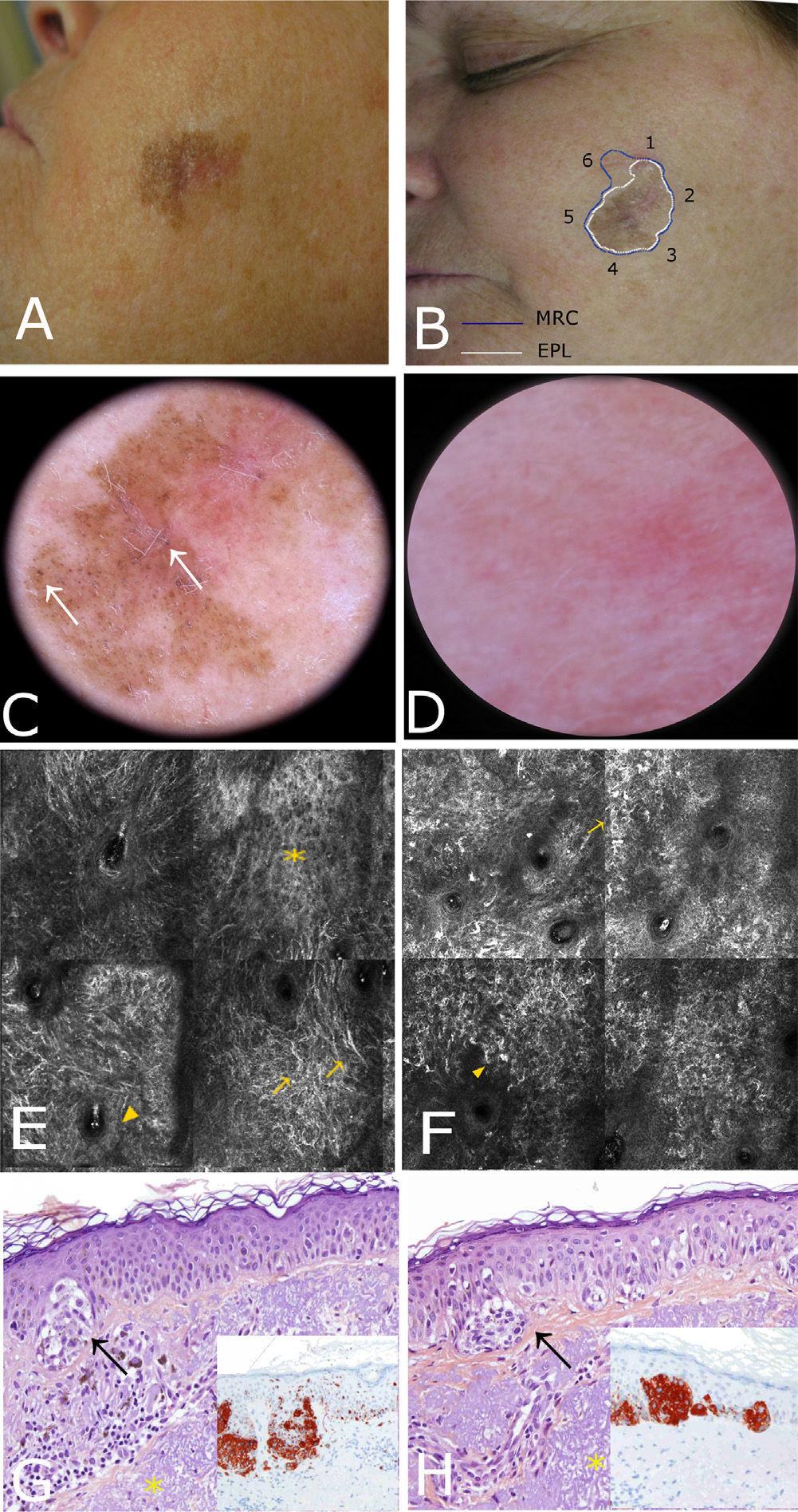 Clinical Usefulness of Reflectance Confocal Microscopy in the ...