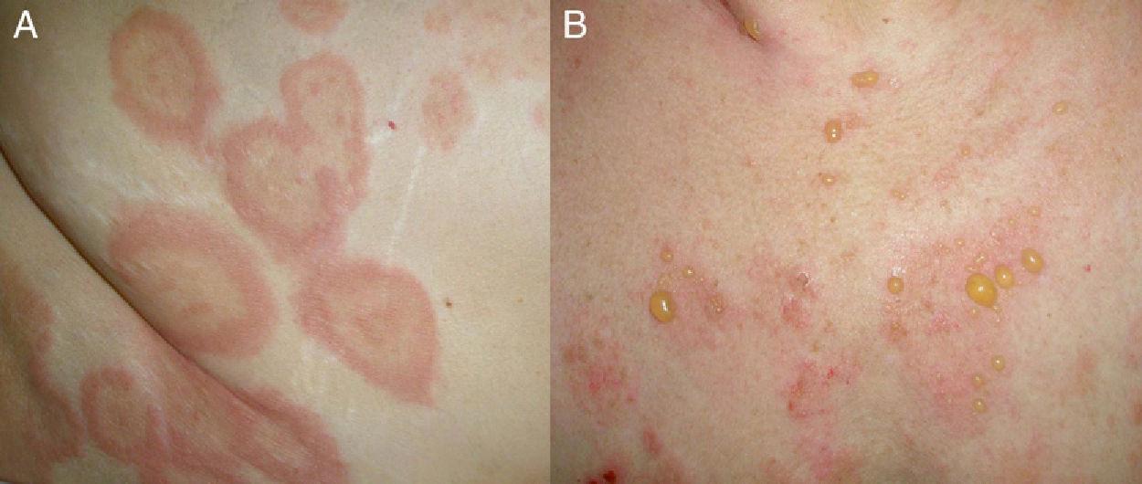 Bullous Pemphigoid Pictures