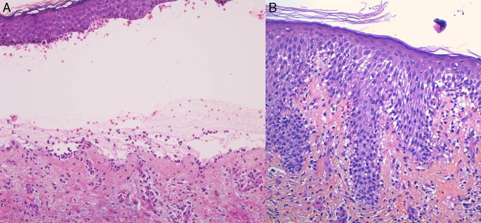 Mucous Membrane Pemphigoid Histology