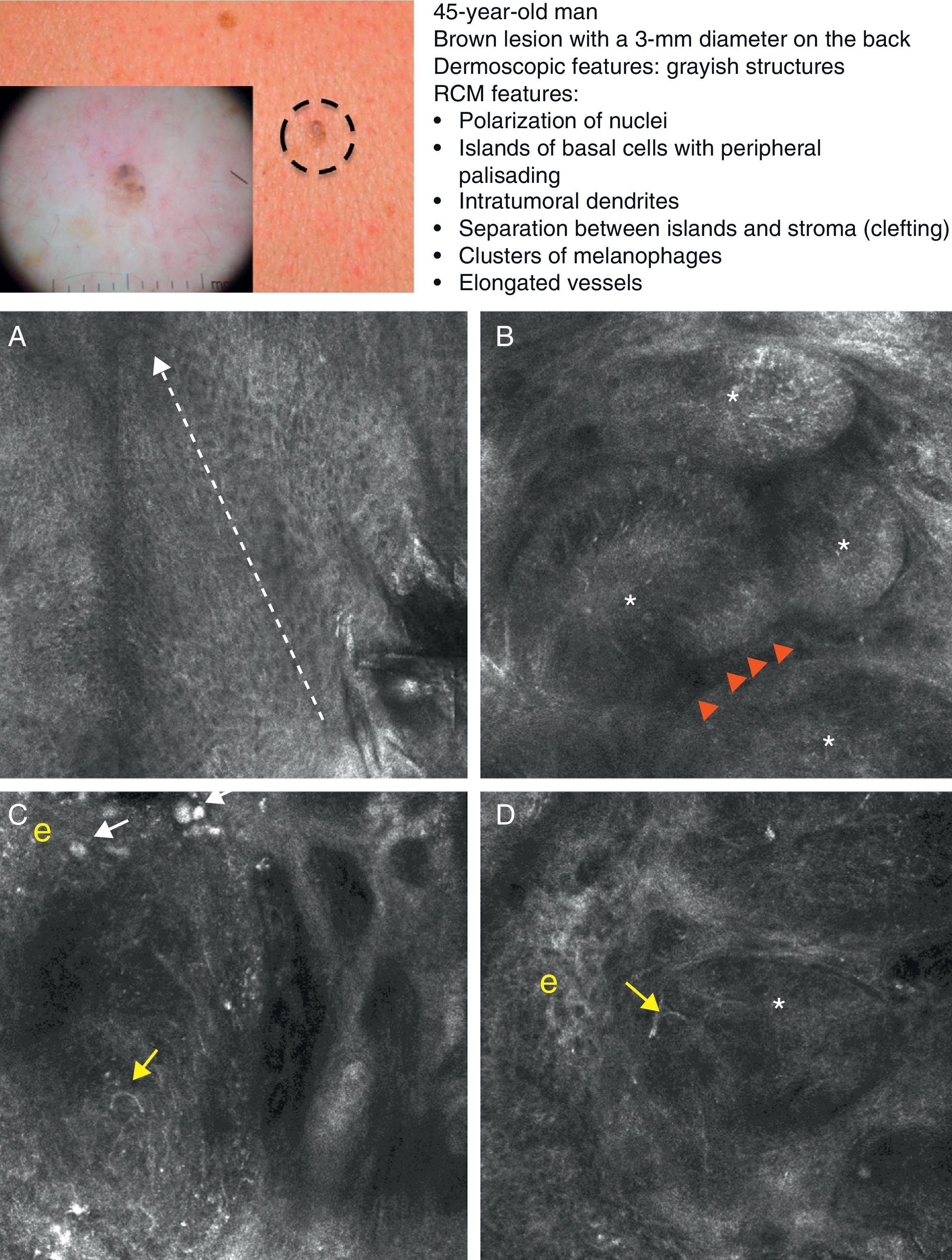Confocal Microscopy Patterns in Nonmelanoma Skin Cancer and Clinical ...