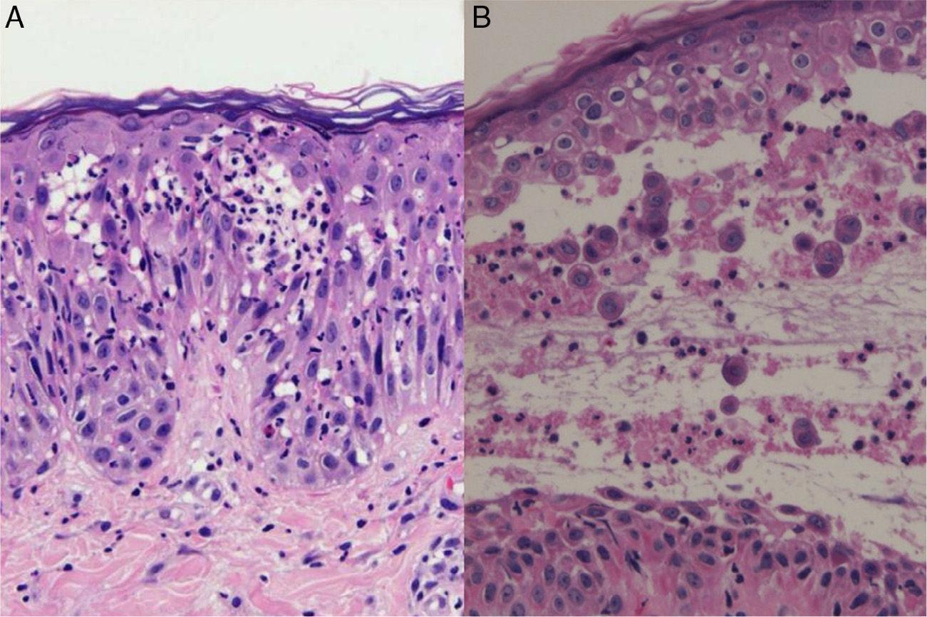 Pemphigus Foliaceus Histology