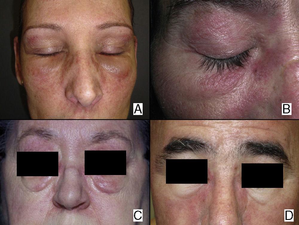Paraneoplastic Dermatomyositis: A Study of 12 Cases | Actas Dermo ...