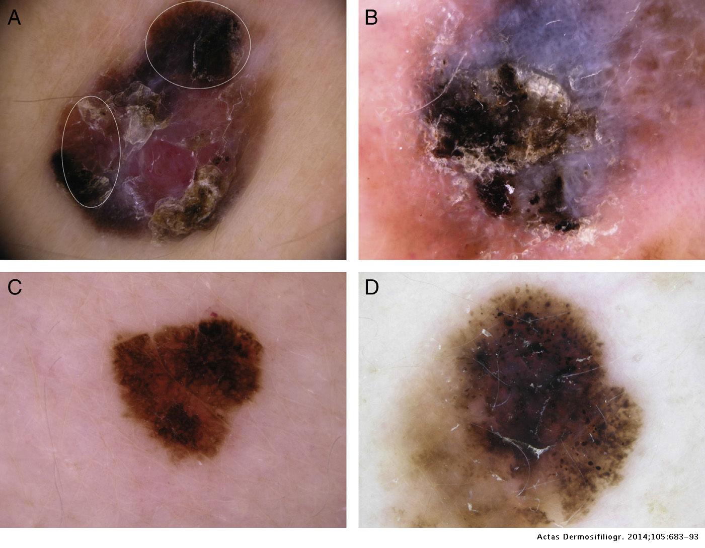 Melanoma Dermoscopy