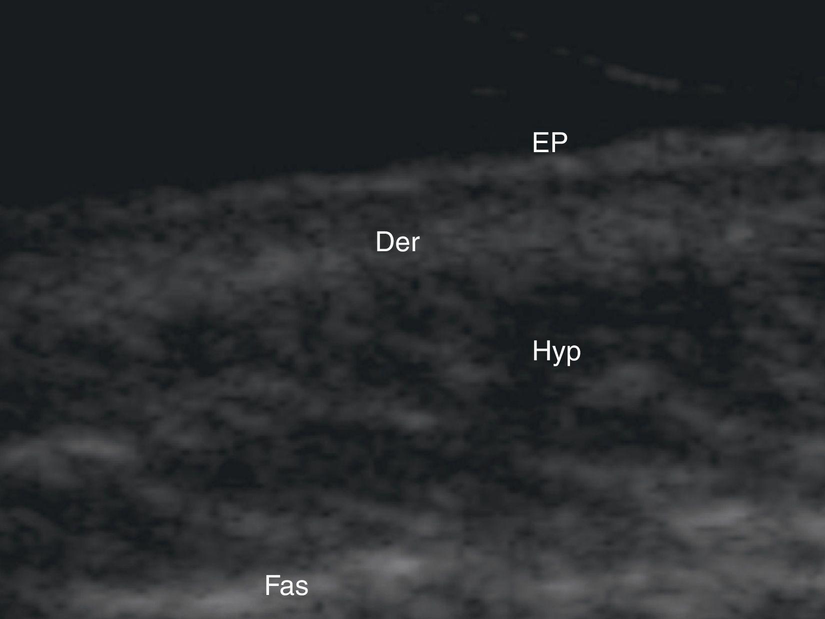 Ultrasound Skin Imaging | Actas Dermo-Sifiliográficas