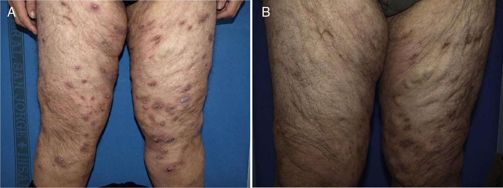 Phrynoderma After Biliopancreatic Diversion | Actas Dermo-Sifiliográficas