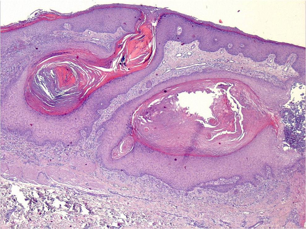 Phrynoderma After Biliopancreatic Diversion | Actas Dermo-Sifiliográficas
