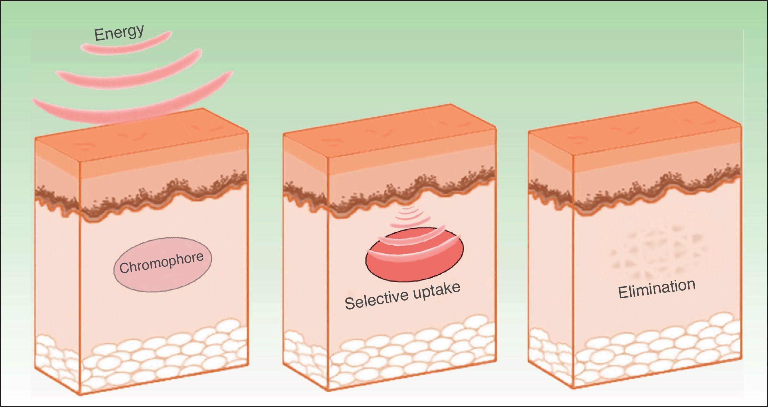 Current Indications and New Applications of Intense Pulsed Light ...
