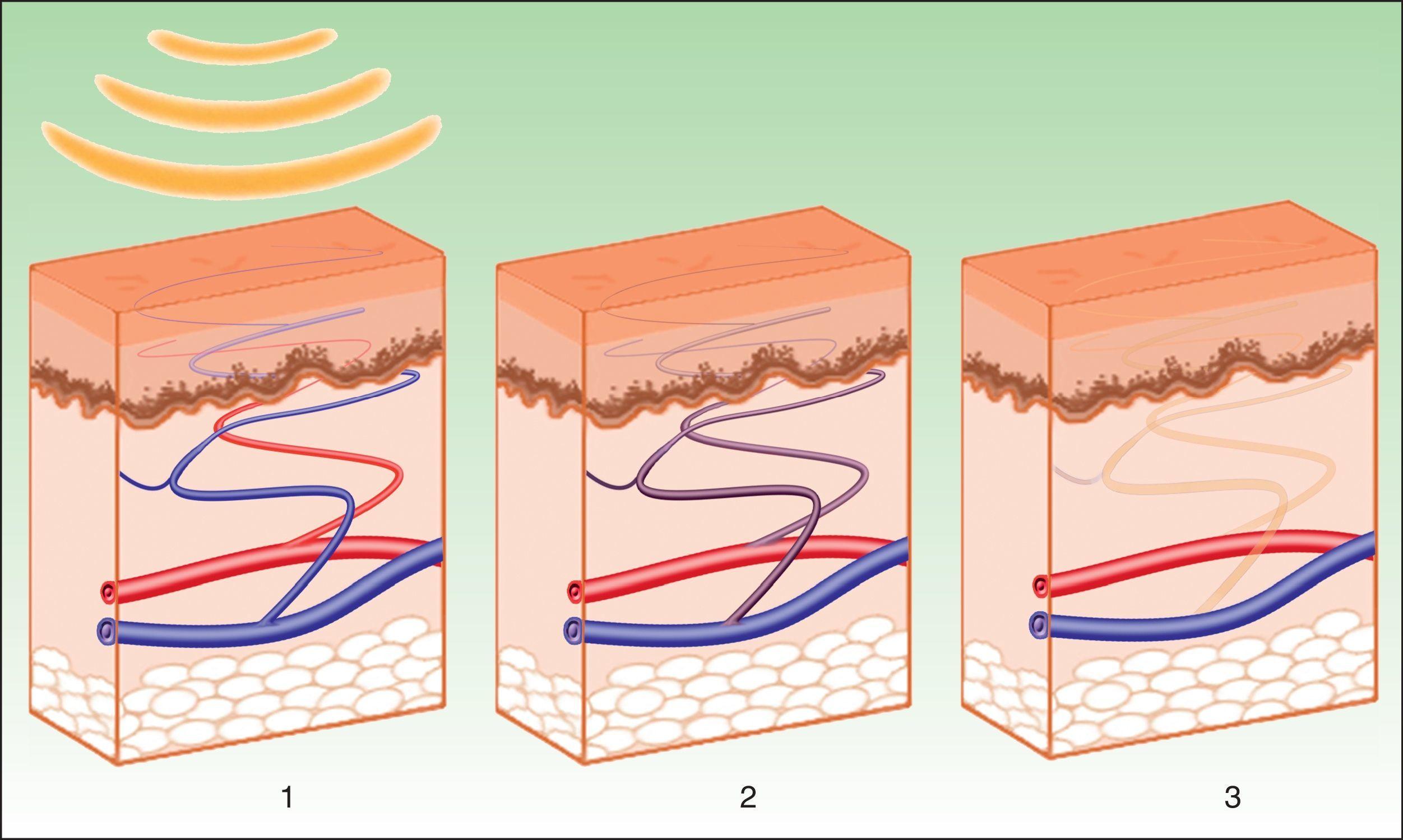 Current Indications and New Applications of Intense Pulsed Light ...