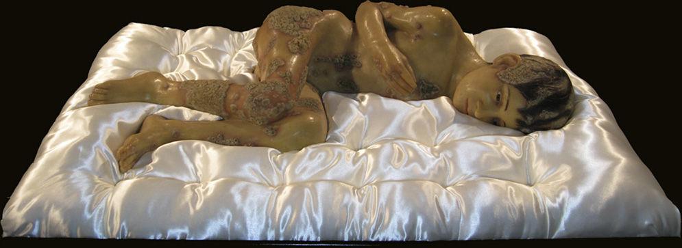 Generalized Favus: The Story of a Legendary Case of Tinea Favosa ...