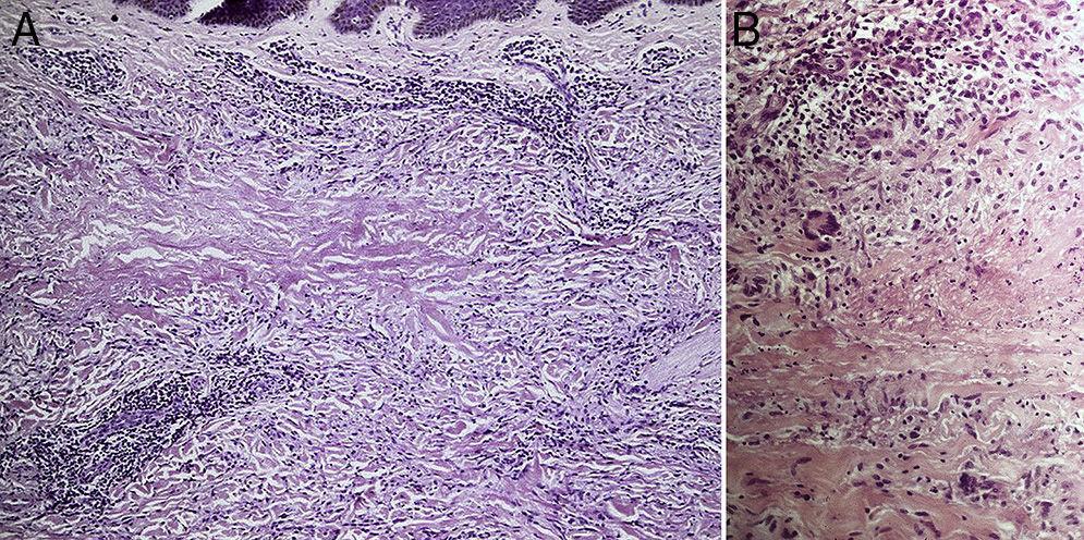 Necrobiosis Lipoidica Diabeticorum Histology