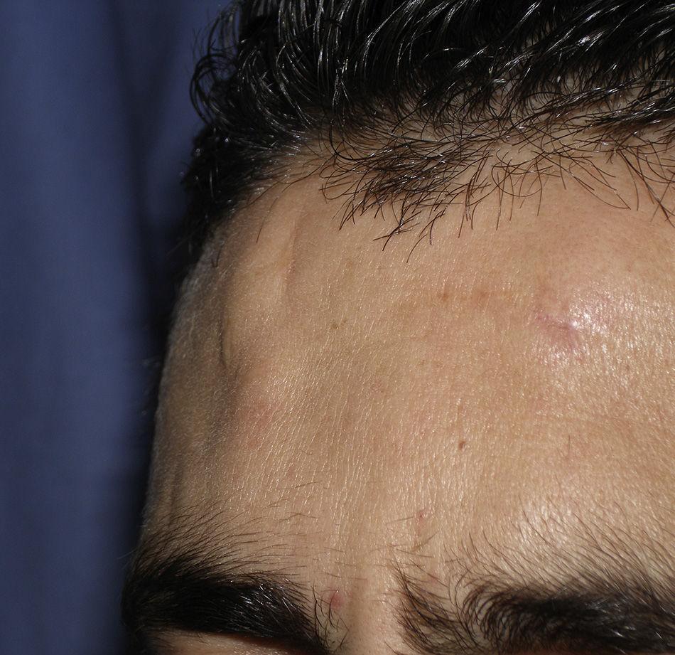 Nodules on the Forehead Associated With Generalized Lymphadenopathy ...