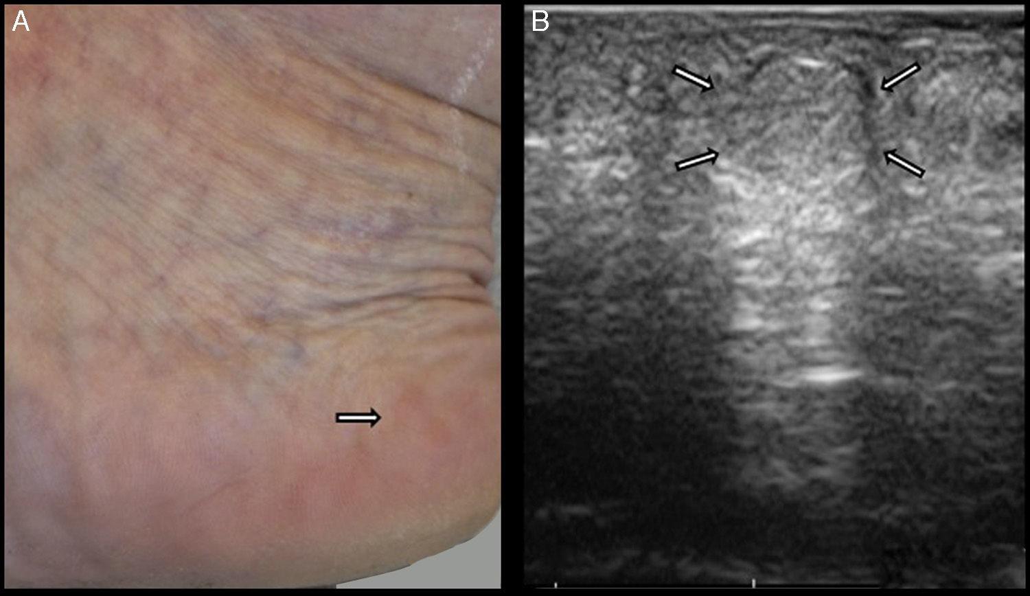 Usefulness of High-Frequency Ultrasound in the Diagnosis of Piezogenic ...