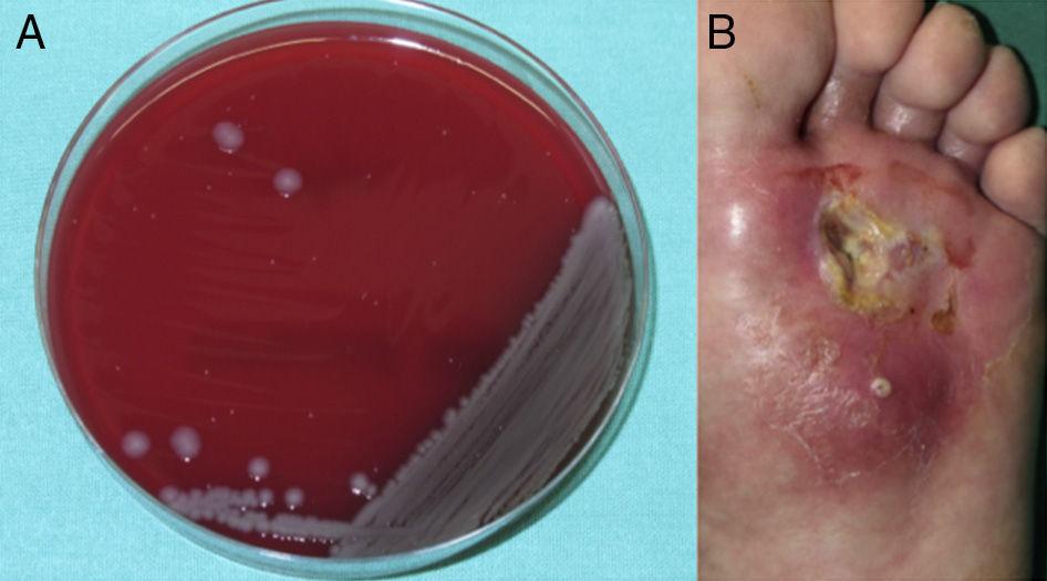 Vibrio Parahaemolyticus Skin Infection