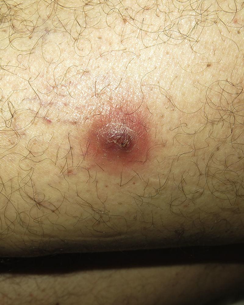 Staph Infection Inner Thigh