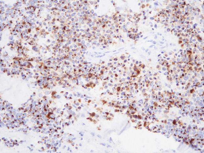 Stony-Hard Subcutaneous Mass on the Arm of a Young Woman | Actas Dermo ...