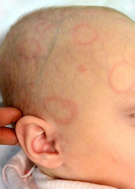 Granuloma Annulare Face