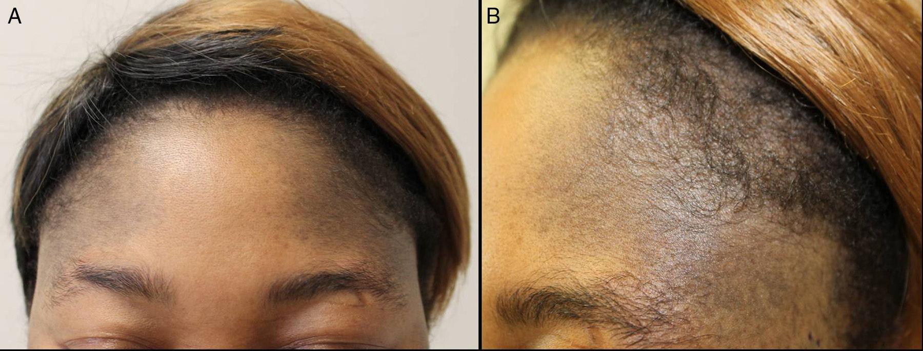 Acquired Symmetric Facial Hyperpigmentation | Actas Dermo-Sifiliográficas
