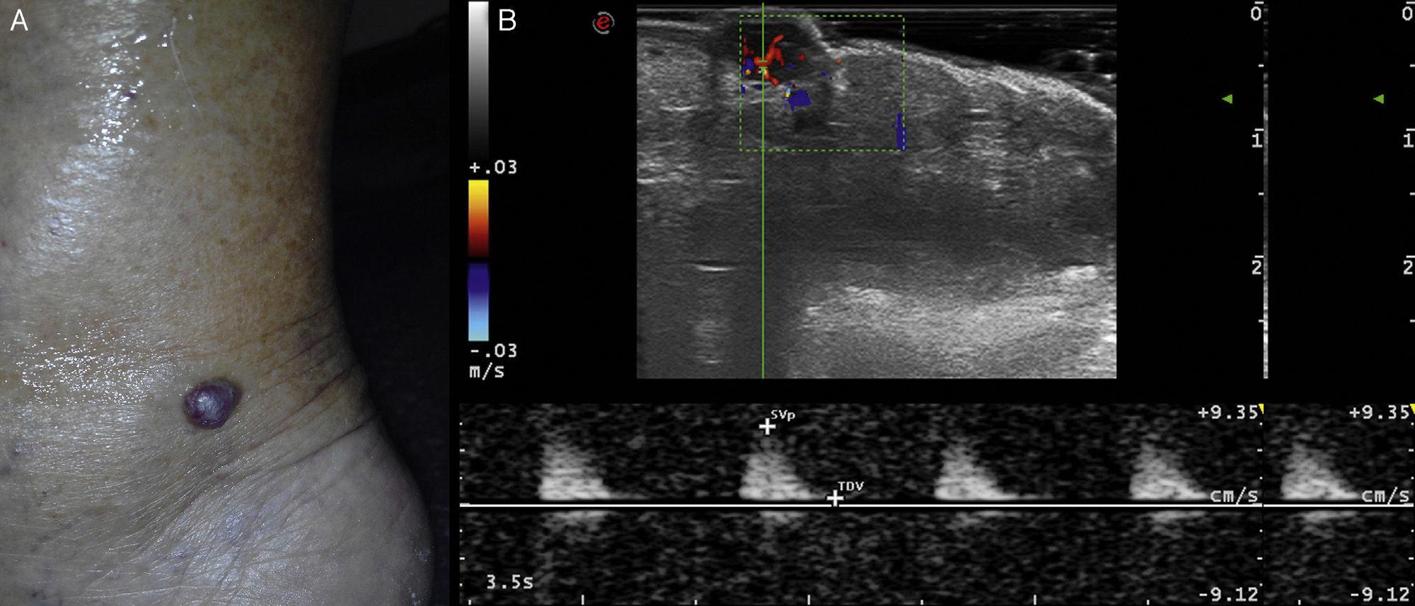 Skin Ultrasound in Kaposi Sarcoma | Actas Dermo-Sifiliográficas